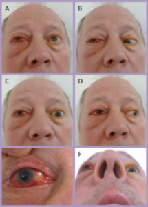 Lateral Canthotomy – EMbeds.co.uk