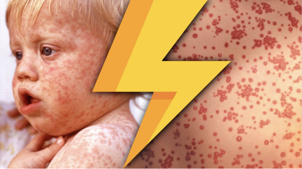 Measles – EMbeds.co.uk